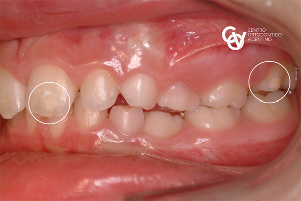 MIH or hypomineralization of incisors and molars - Dentisti Vignato Vicenza
