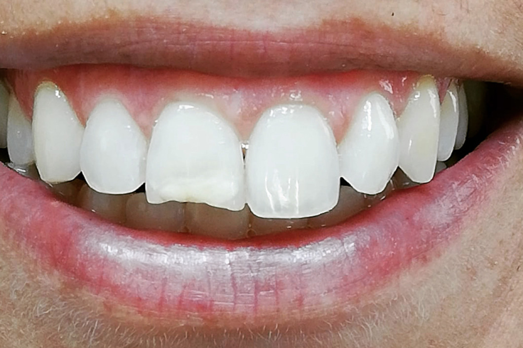 Le macchie sui denti che ci impediscono di sorridere… - Dentisti ...